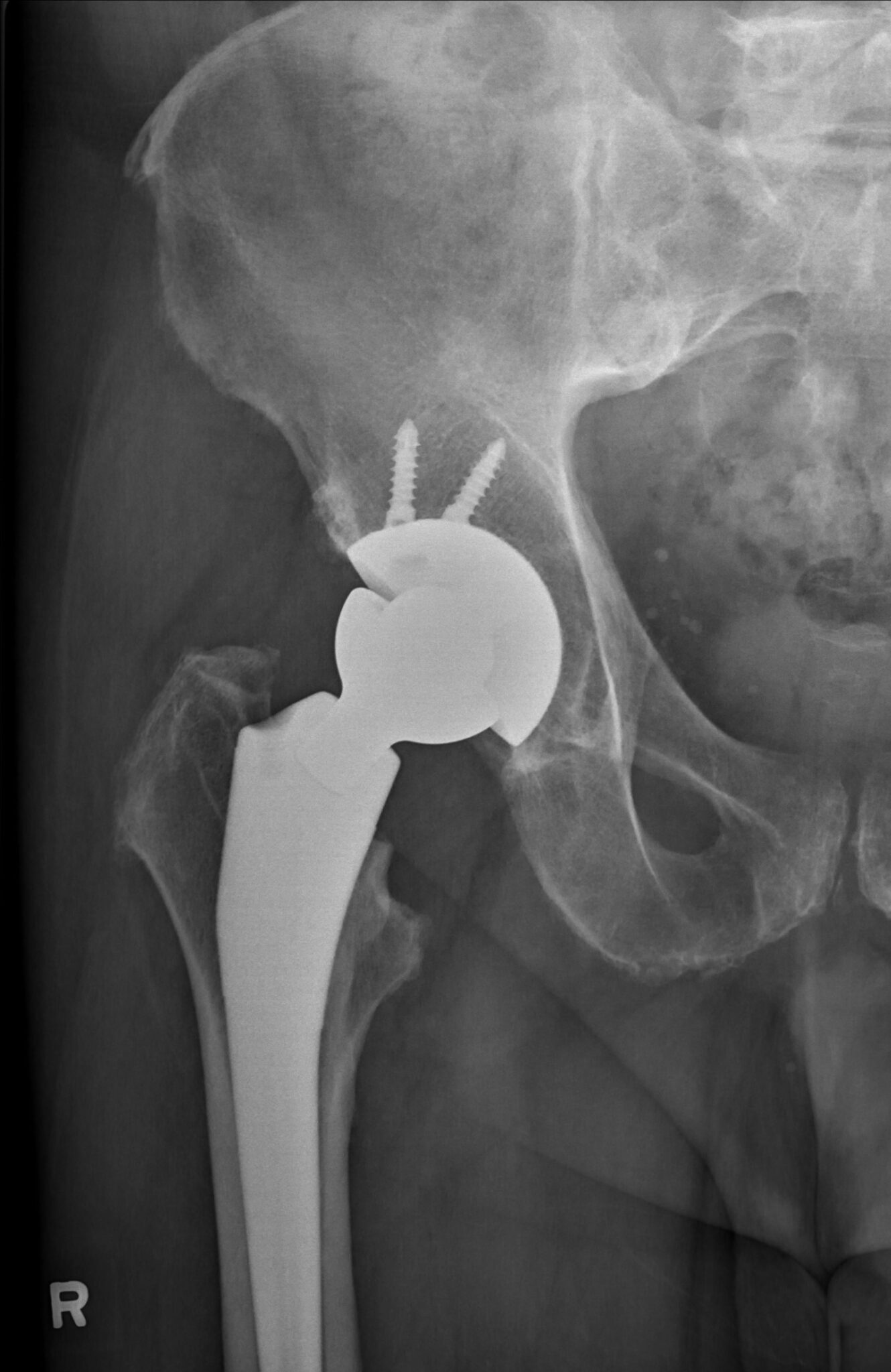 Hip Innovation Technology Develops Reverse Hip System - BONEZONE