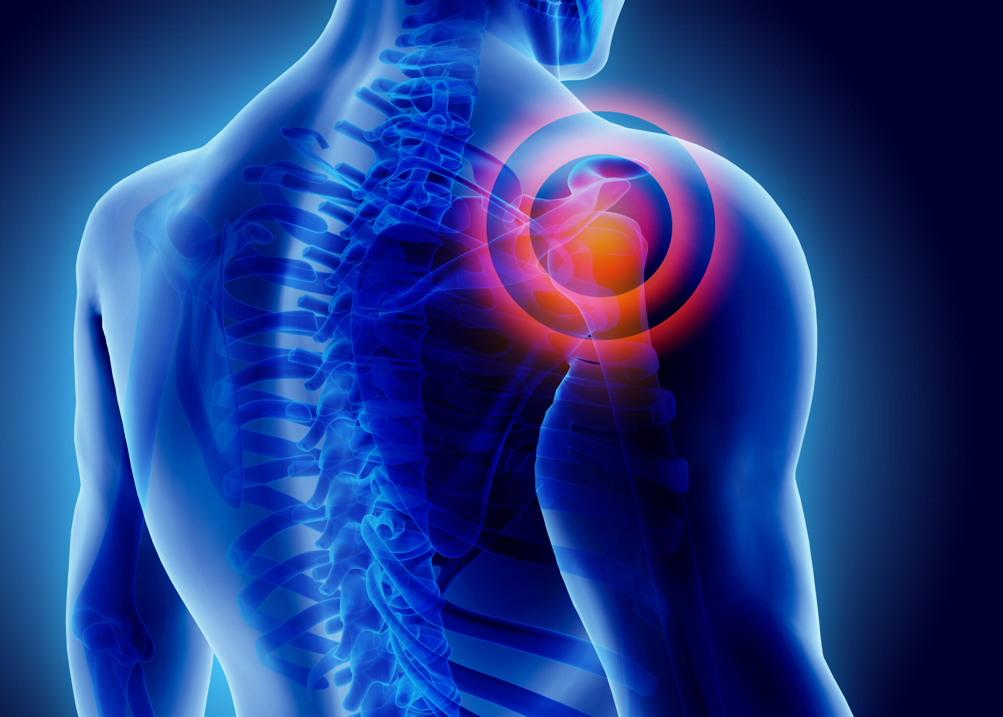 DePuy Synthes Gains Clearance for INHANCE Reverse Total Shoulder