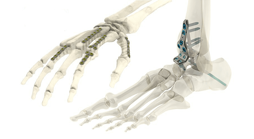 FDA 510(k) Recap: Solutions for Ankle Replacement, Bone Repair and ...