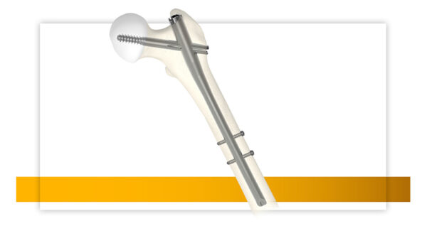 Stryker Expands the Gamma4 Hip Fracture Nailing System - BONEZONE