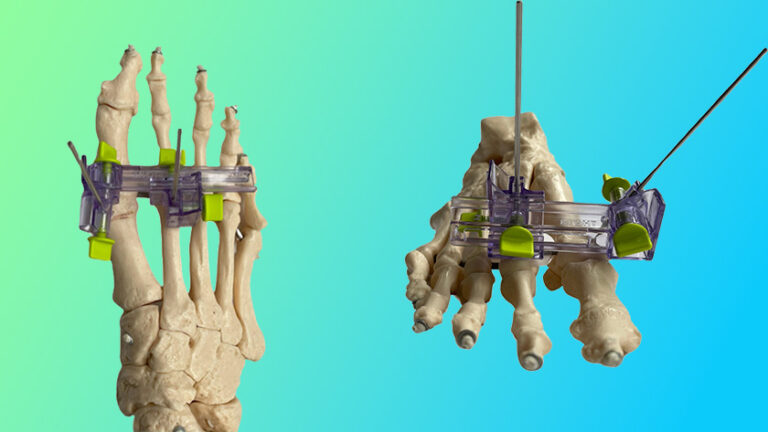 RELJA Innovations Launches Clamp and Foot Plating