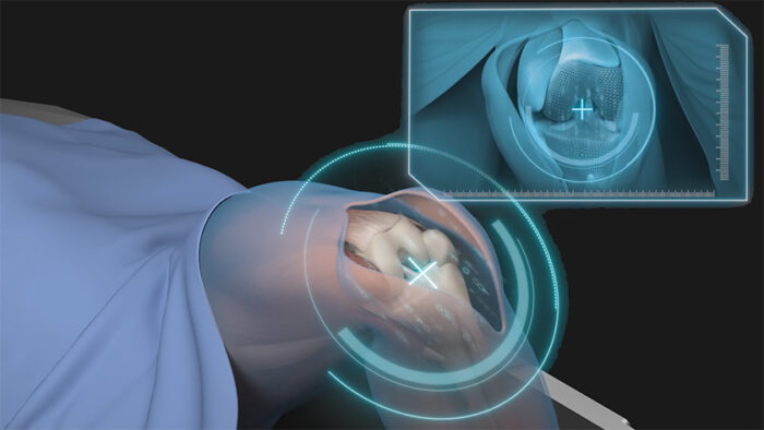 VISIE Debuts Tracking Technology for Total Knee Replacement - BONEZONE