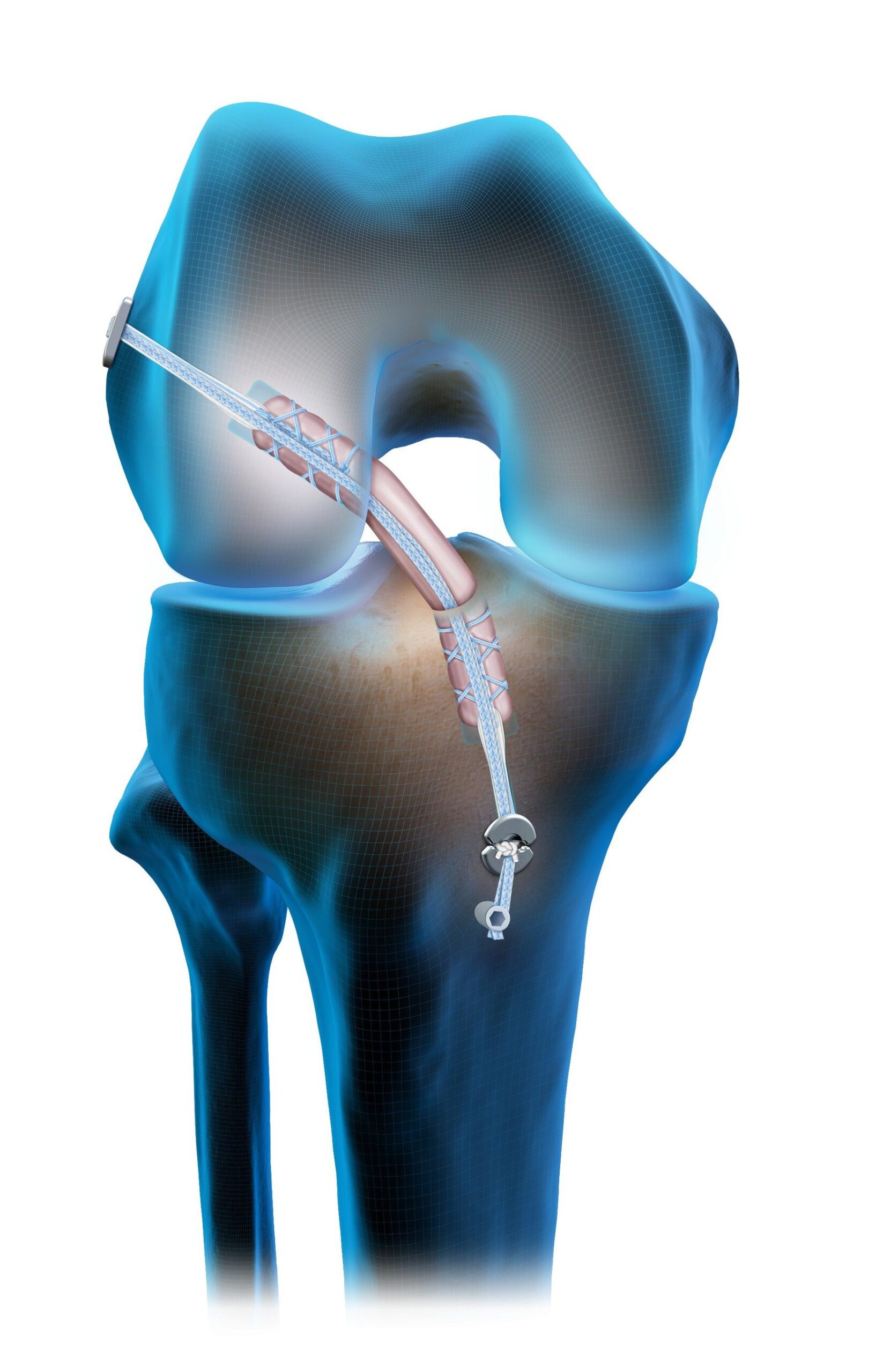 ACL Reconstruction Trends Focus on the Younger Set - BONEZONE