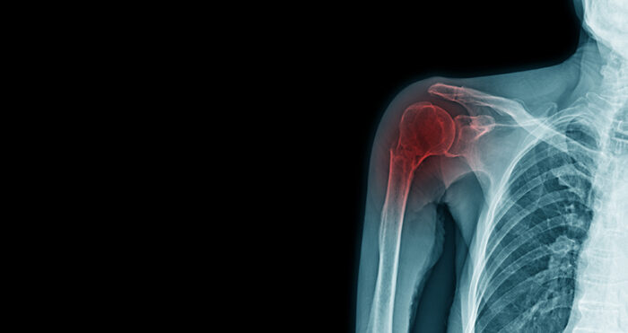 State of the Trauma Market - BONEZONE